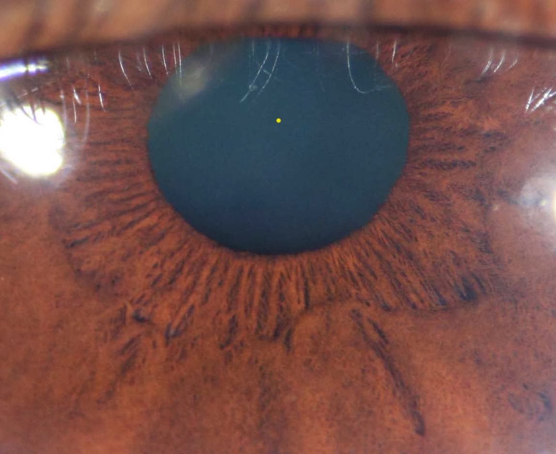 Modern & Multidimensional Iridology: The Combination of Iris Signs - Rx ...