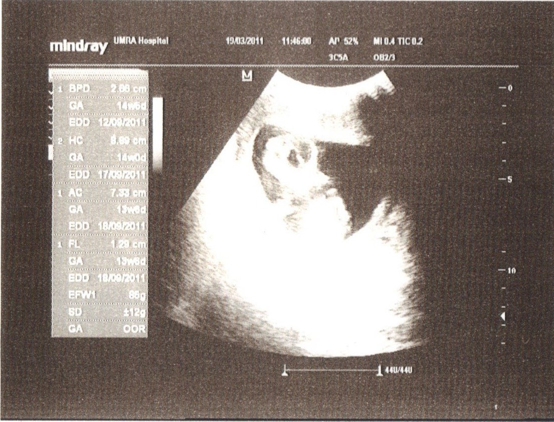 My Pregnancy Day and Progress...: Gambar scan babies...