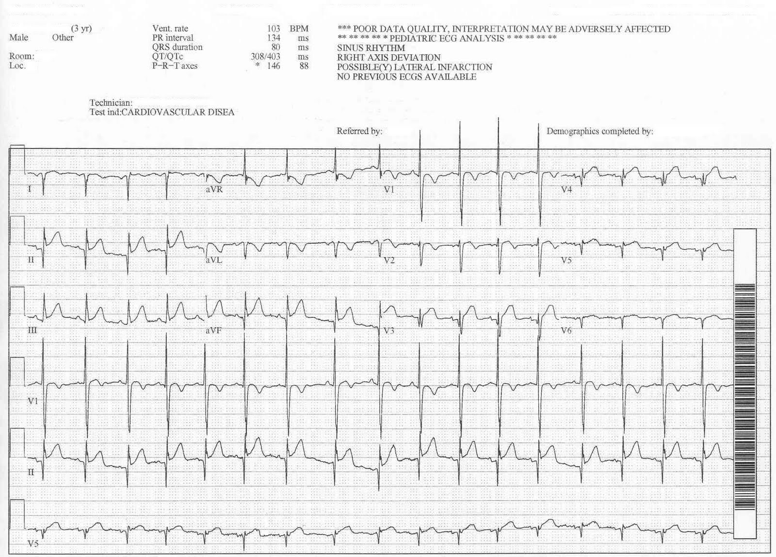 Pedi cardiology: EKG: Dextrocardia