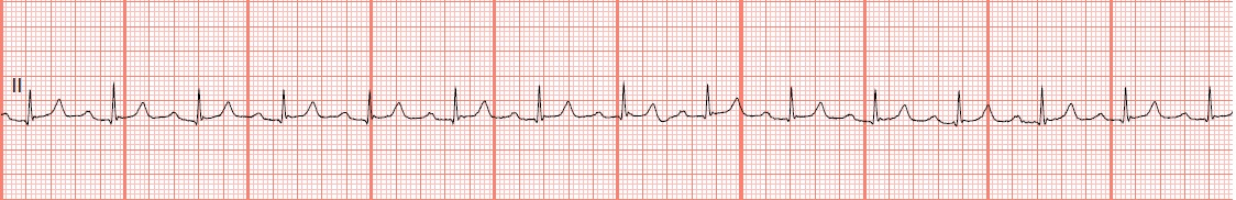 EKG Rhythm Strip Quiz 34