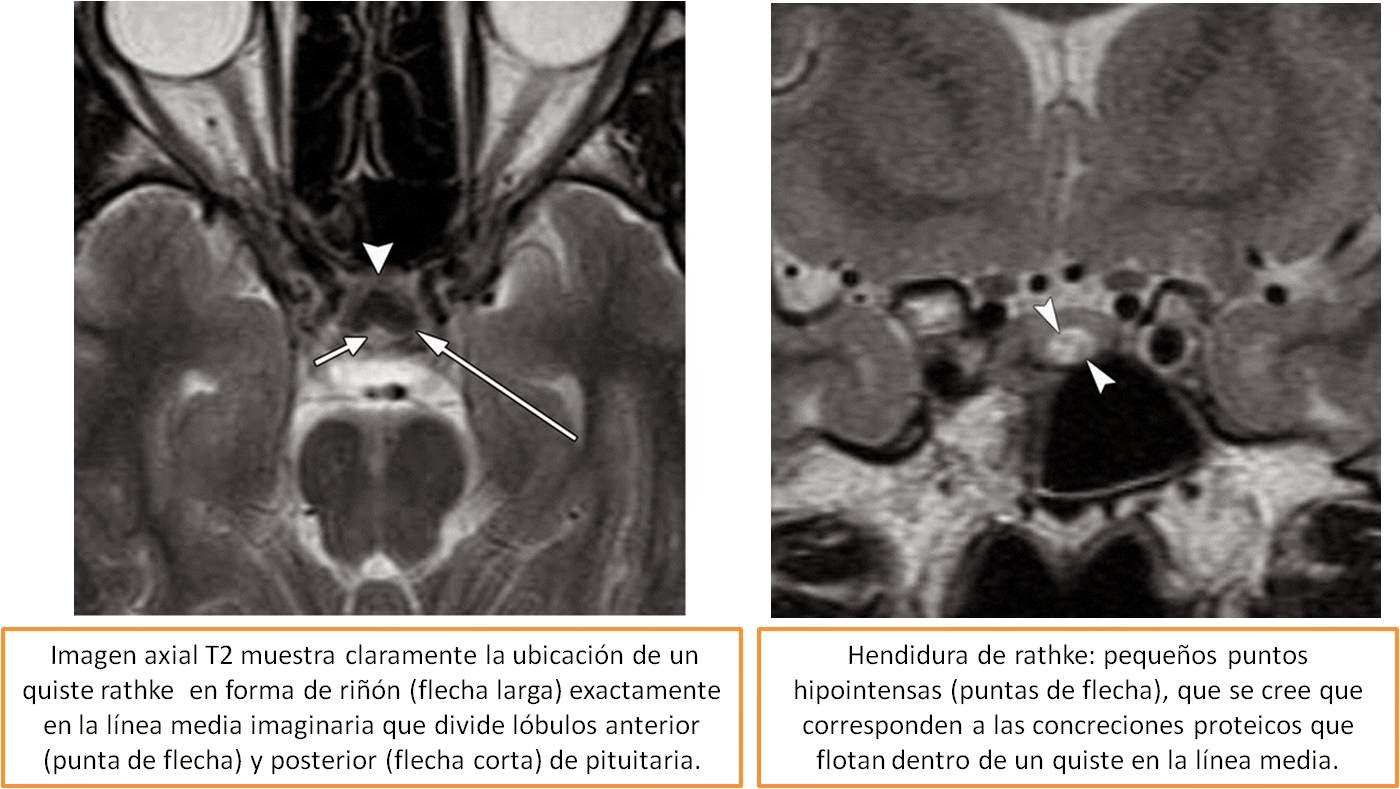 ESPE 203-2013: Patología de región selar: rol de imagenología
