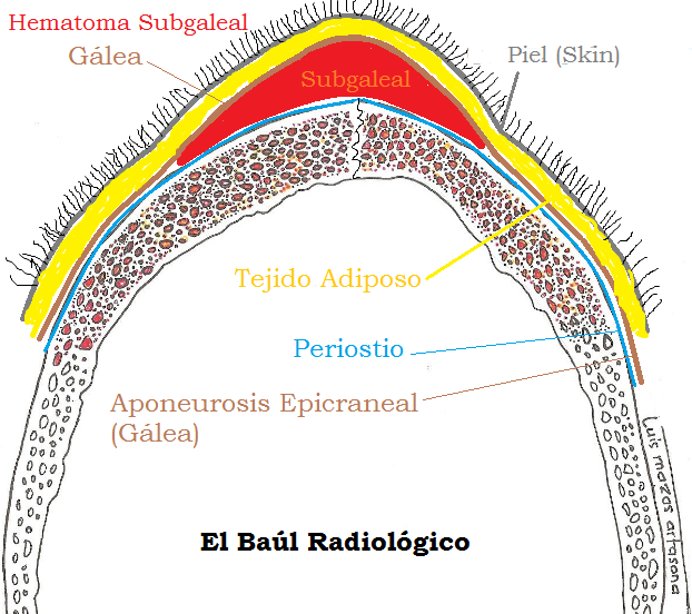 El Baúl Radiológico: 2) HEMATOMA SUBGALEAL: HALLAZGOS EN TOMOGRAFÍA ...