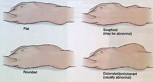 Scaphoid Shaped Abdomen
