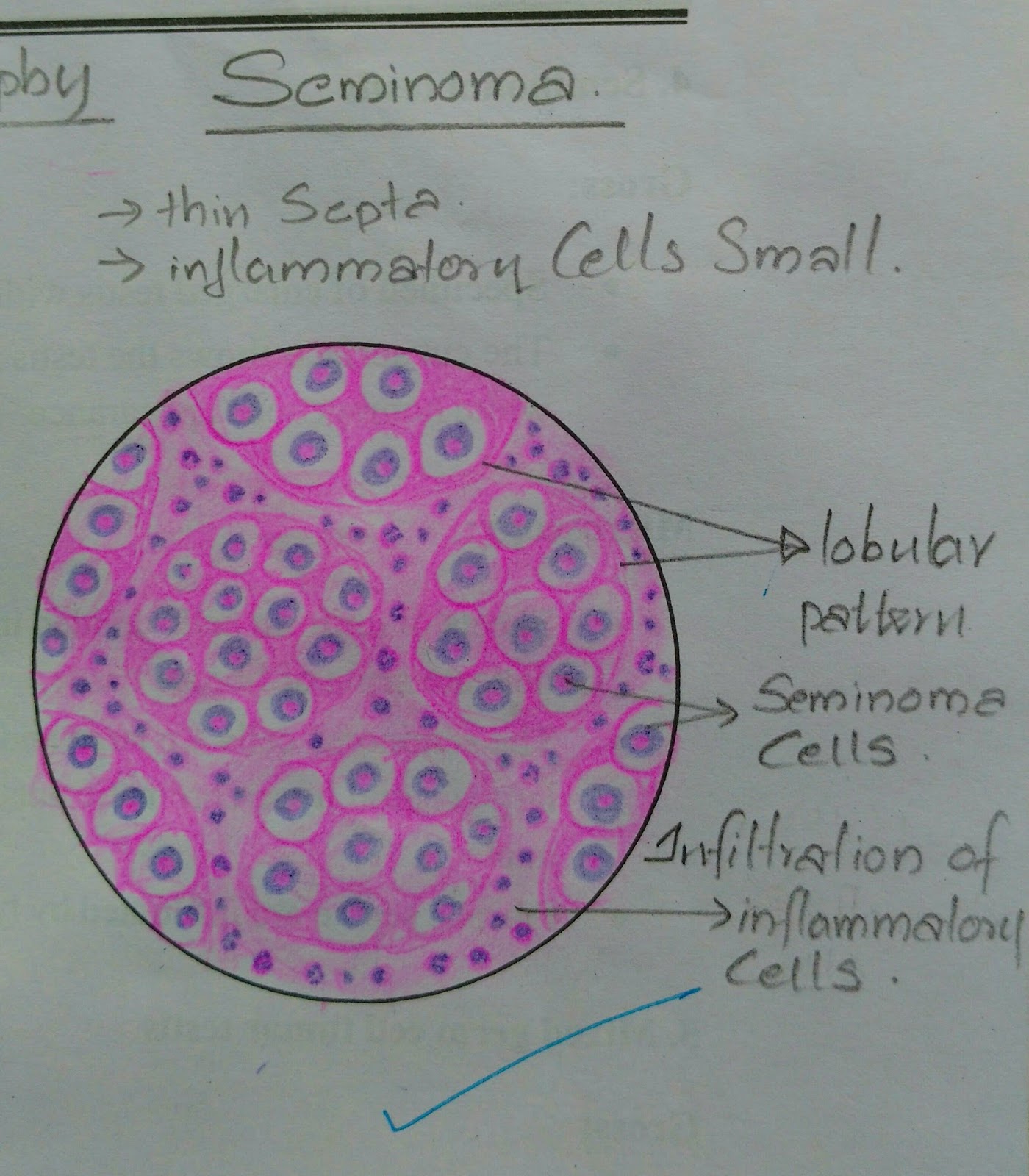 Histopathology Drawings: Seminoma