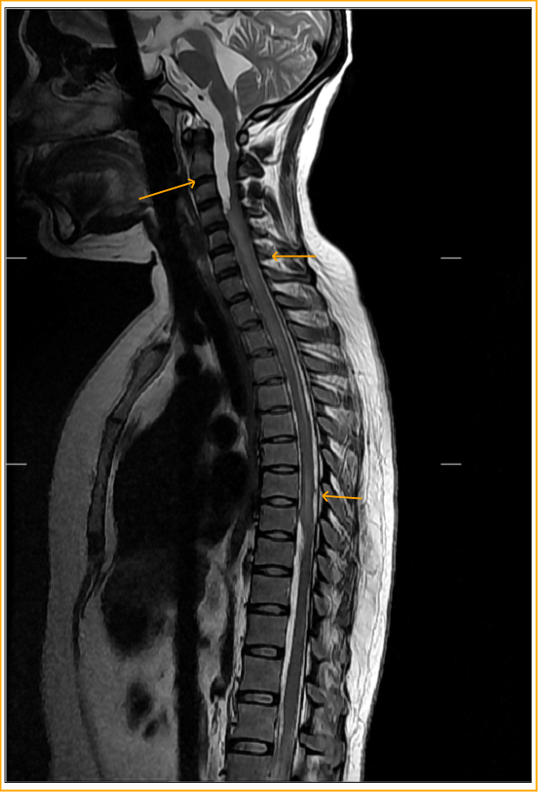 Spinal Meningitis - Sumer's Radiology Blog
