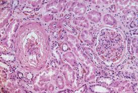 Patología 2013: Arterioesclerosis