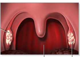 Contoh Asuhan Keperawatan Pada Kasus Faringitis | ASKEP HIPERTENSI