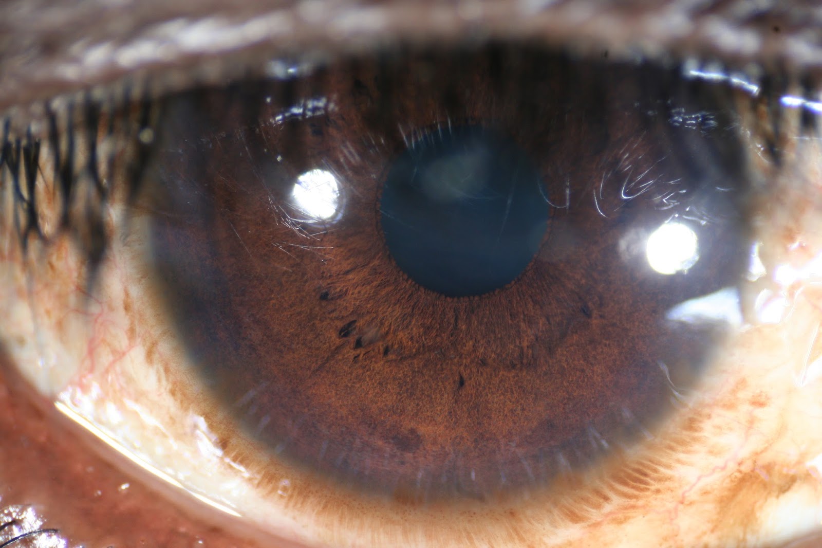 Modern & Multidimensional Iridology: Iris Signs at Internal & External ...