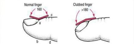 Pediatric OSCE Clinical skills - Hand signs • DNB Pediatrics