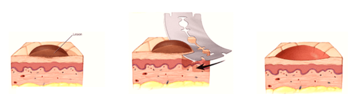 OHIMA Blog: Coding Skin Biopsies