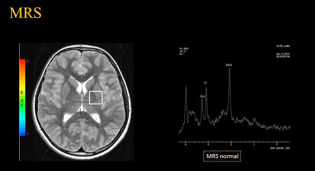 Dr Balaji Anvekar FRCR: Understanding Primary Dystonia with Advanced ...