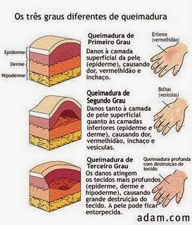 QUEIMADURA | Izabel dos Santos