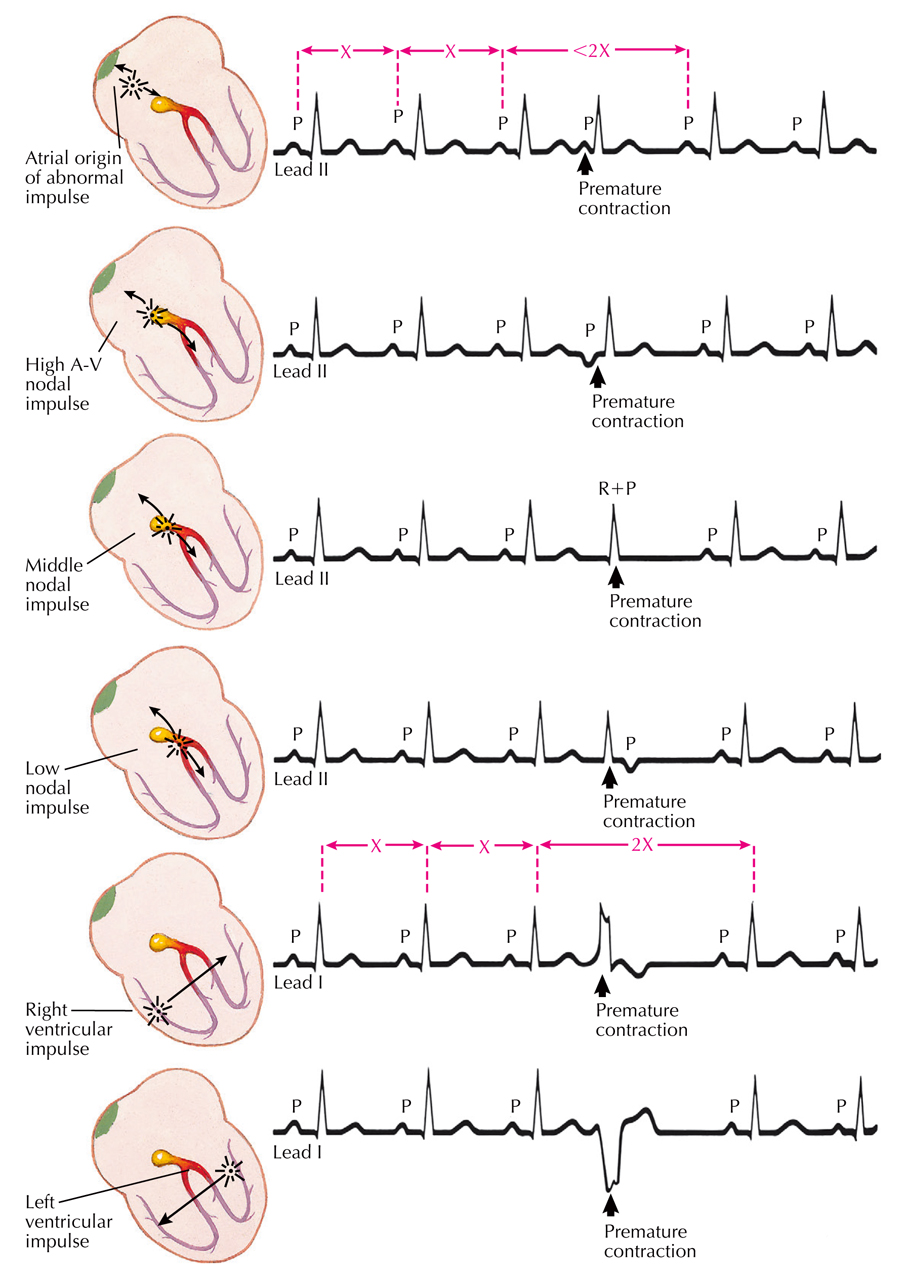 Medical Terms & Сlinical Сases : Premature Contraction