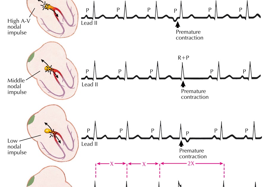 Medical Terms linical ases Premature Contraction medical-terms-linical-ases-premature-contraction