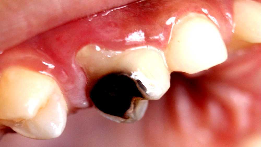 Early childhood caries