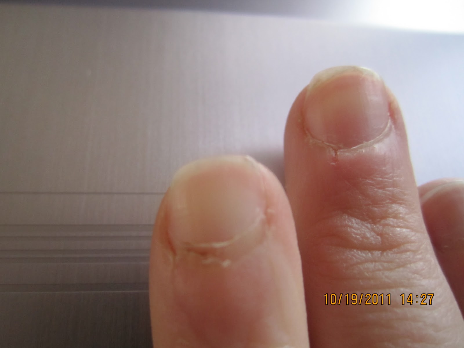 Nail fold abnormalities - Scleroderma