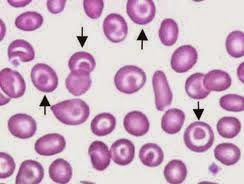 HEMATOLOGIA: CODOCITOS