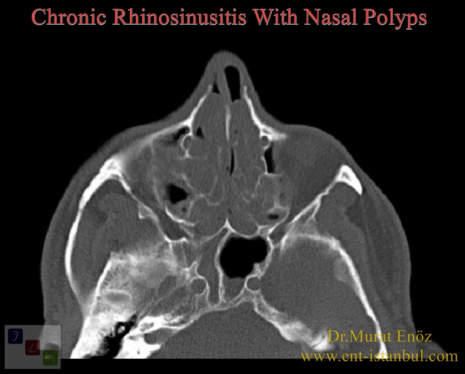 Nasal Polyp - Definition, Symptoms, Diagnosis and Treatment