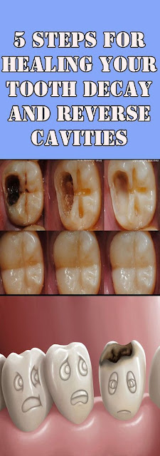 REVERSE CAVITIES AND HEAL TOOTH DECAY WITH THESE 5 STEPS! - DIY CRAFT PLUS