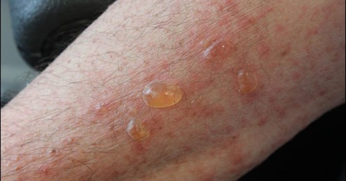 What is the Ayurvedic treatment of Autoimmune Bullous Skin Disease ...