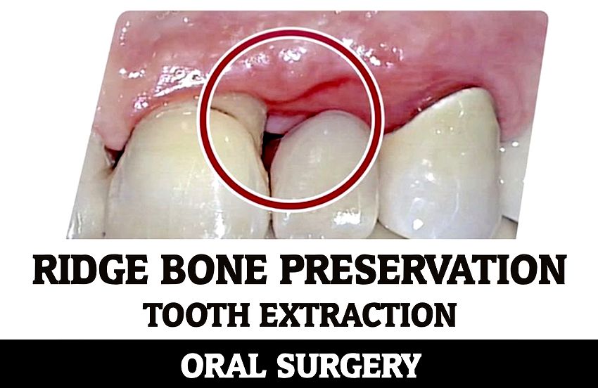 TOOTH EXTRACTION: Ridge Bone Preservation