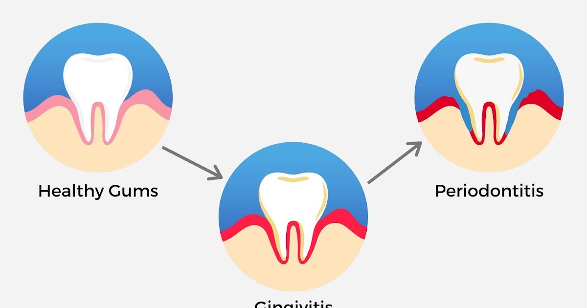 Periodontitis ,Gum Disease and how to treat it.