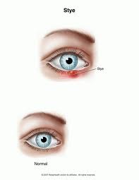 lower eyelid