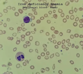 Iron deficiency anemia (IDA)