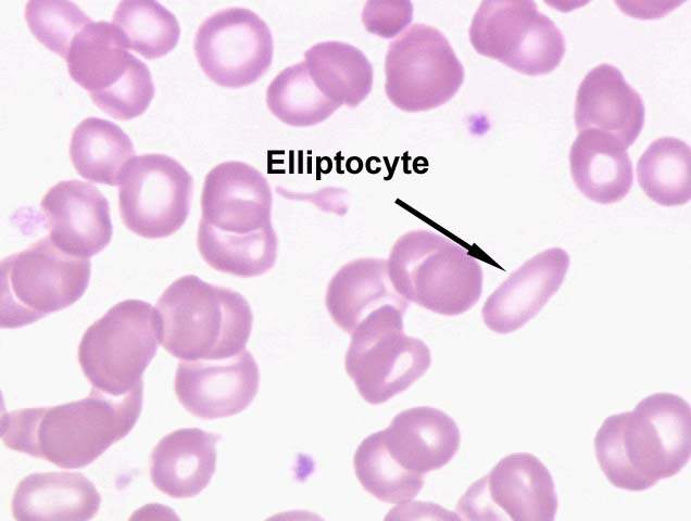 Hello USA: elliptocytes