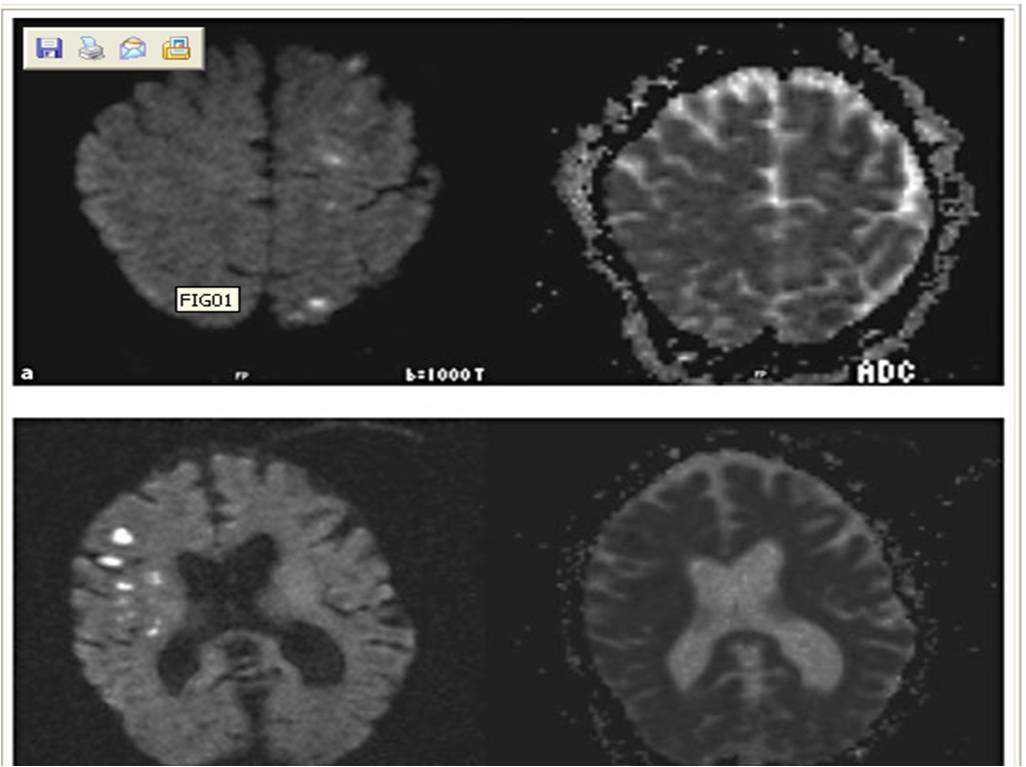 Image Bank: Scattered vs String of pearls signs in MCA/ICA stenosis