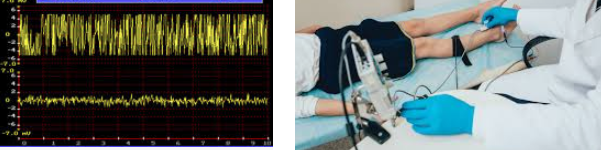 Lombalgies: UN ELECTROMYOGRAMME: POURQUOI FAIRE