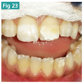 Molar Incisor Hypomineralization (MIH): Conservative Treatment Approach
