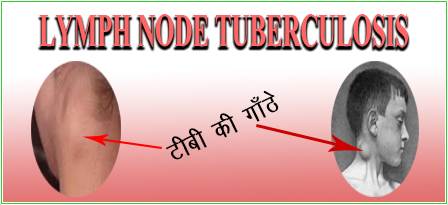 लिम्फ नोड ट्यूबरक्लोसिस क्या है ? जाने What is lymph node tuberculosis ...