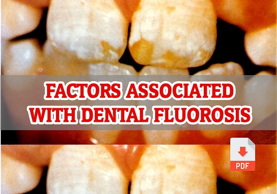 PDF: Factors associated with Dental Fluorosis - Ovi Dental