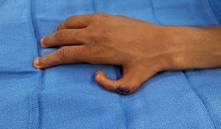 Not the typical hand deficiency- ulnar cleft hand | Congenital Hand and ...