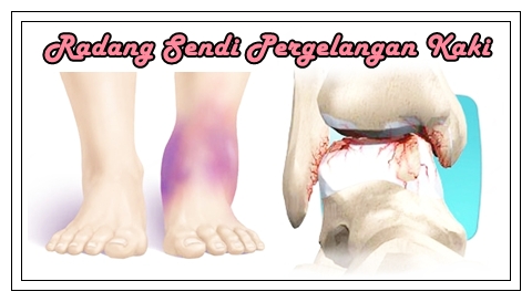 Obat Radang Sendi Pergelangan Kaki Tanpa Efek Samping ~ Gejala Pantangan dan Penyebab