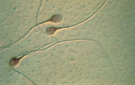 dudas gine: INFERTILIDAD MASCULINA: EL ESPERMIOGRAMA