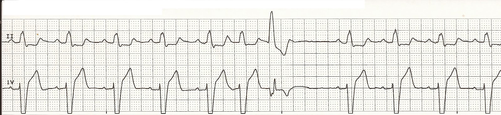 EKG Rhythm Strip Quiz 46