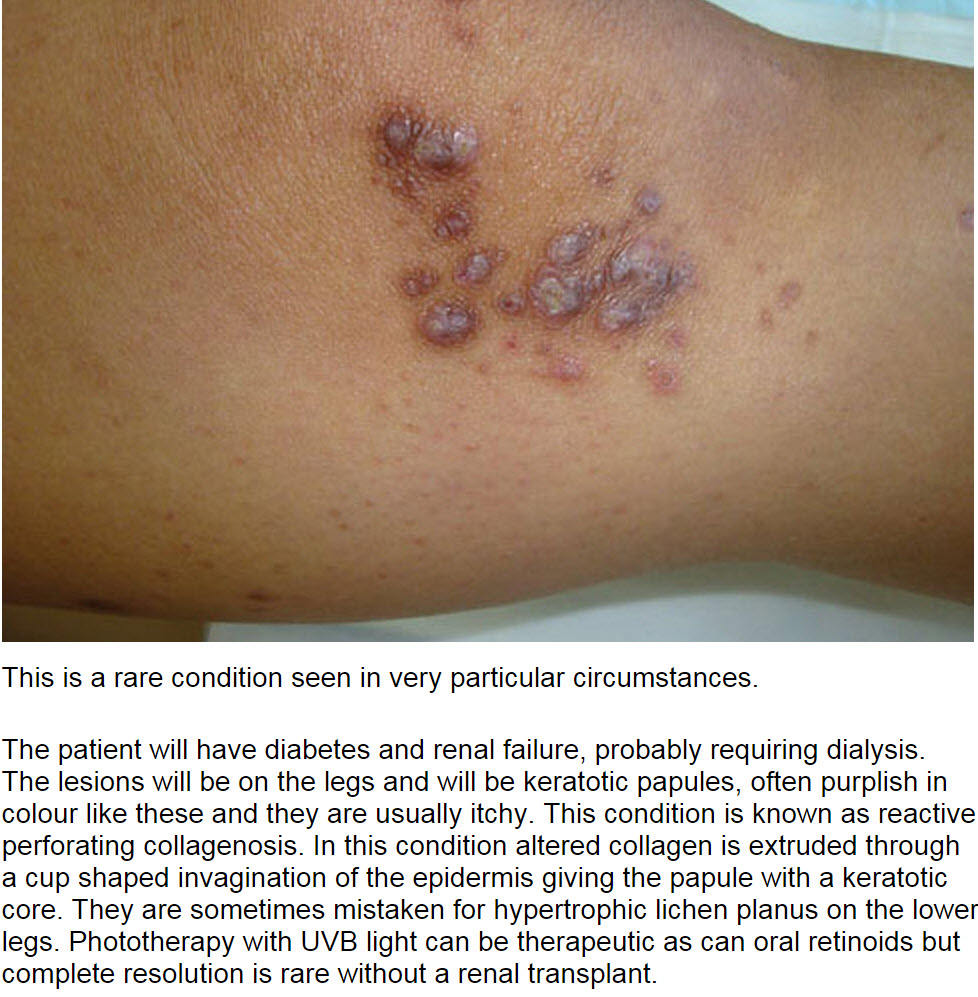 Consultations in Dermatology: Reactive perforating collagenosis