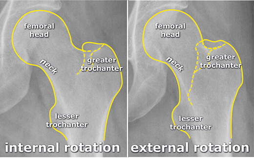CamRadTech: Hip X ray