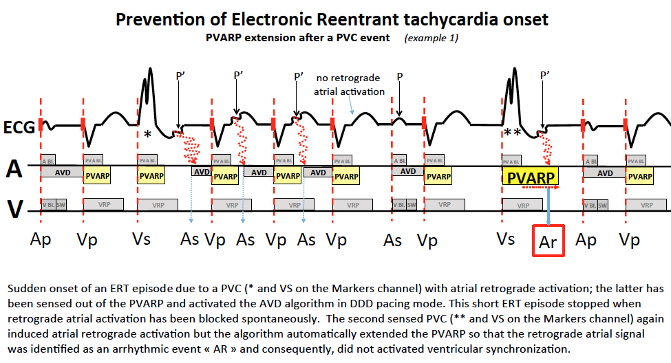 Dr Han Naung @ Henry Han : Electrophysiology and Heart Rhythm : AV ...