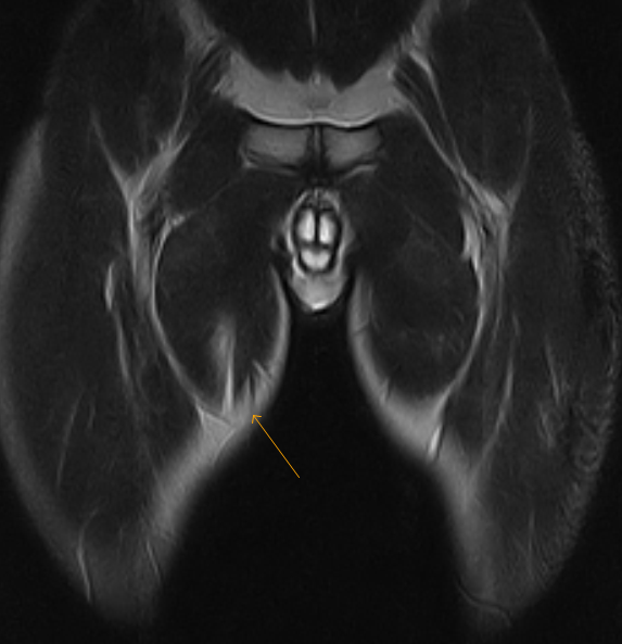 Adductor Strain Mri Sumers Radiology Blog