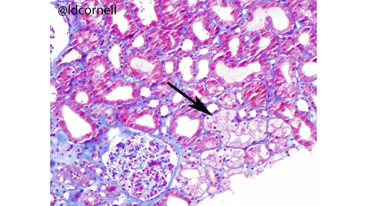 Nephron Power: Topic Discussion: Osmotic Nephrosis