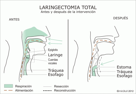 Plan de Cuidados a un Paciente con Laringectomia: "Bienvenidos a ...