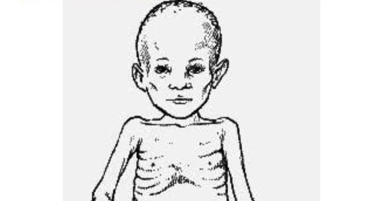 Marasmus: Causes, symptoms, and treatment