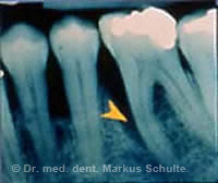 Rontgen periodontitis, dental granuloma, dan kista radikuler - the ...