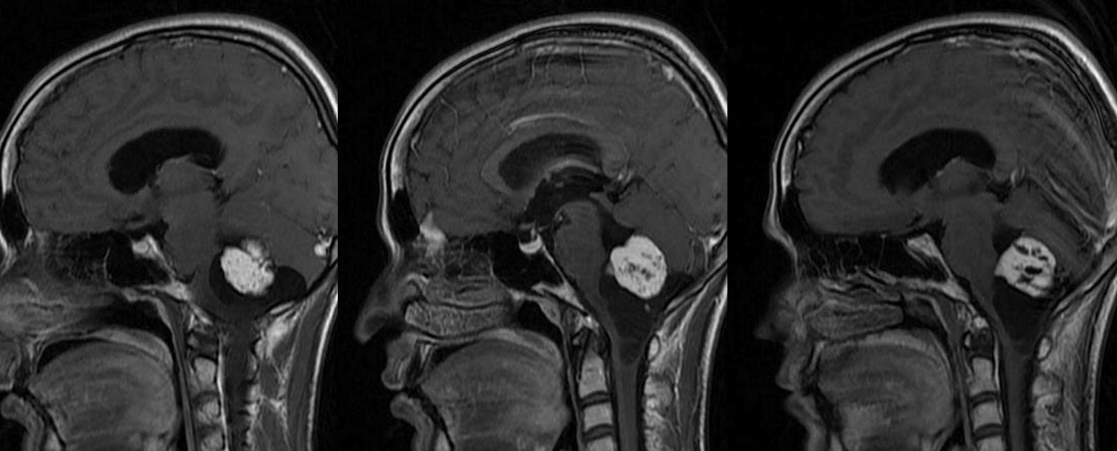 Dr Balaji Anvekar FRCR: Hemangioblastoma