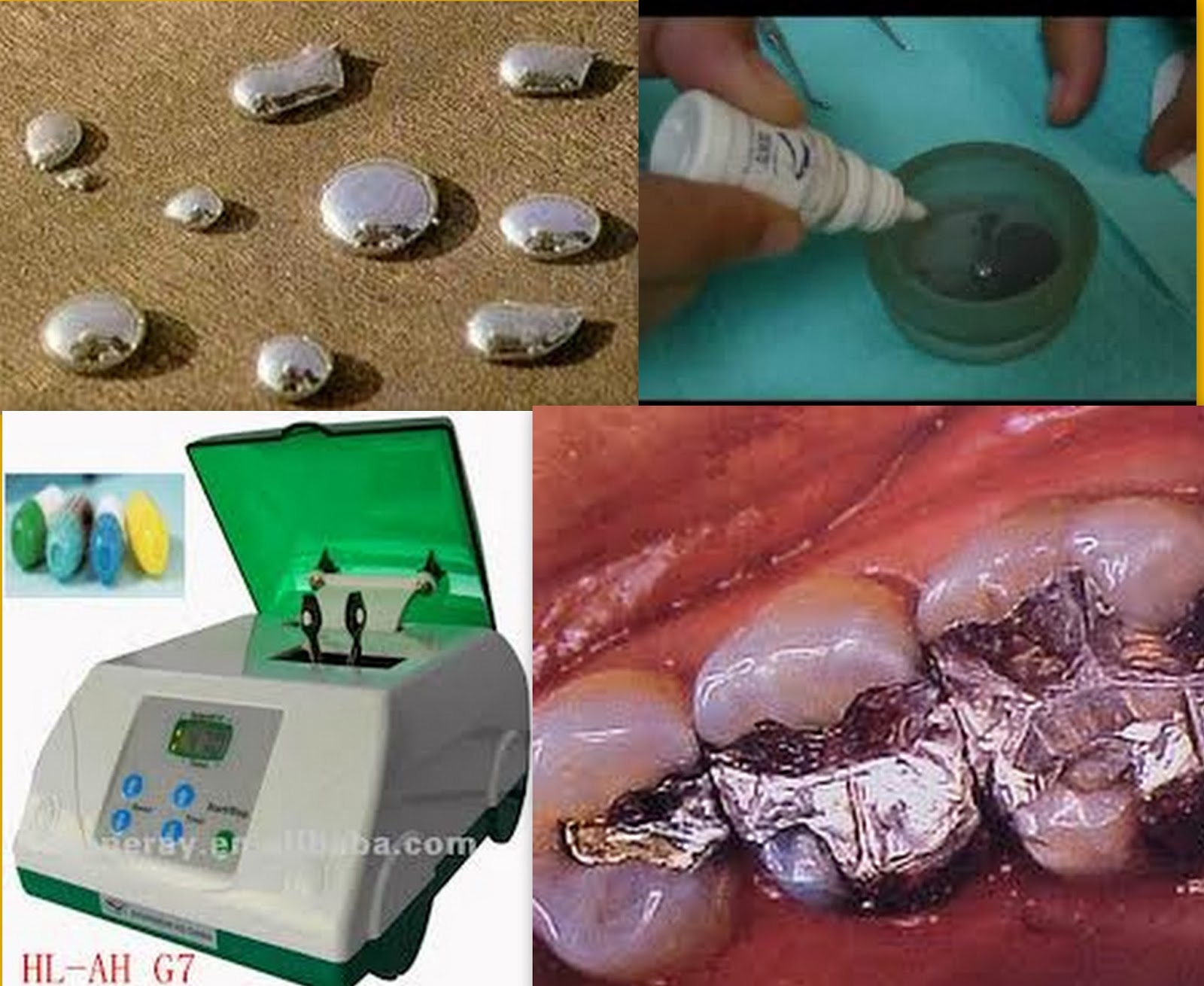 jaitt odonto social: LLEGÓ A SU FIN LA AMALGAMA DENTAL