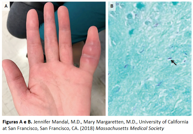 Quais as causas e sintomas da tuberculose extrapulmonar? - Saber Atualizado