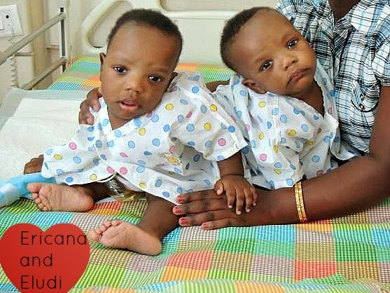 Being Daryl: Surgical Separation of Pygopagus twins at Apollo Children ...